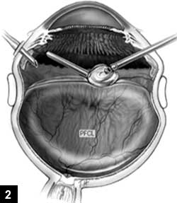 Retinal surgeon explains how to handle dropped nucleus